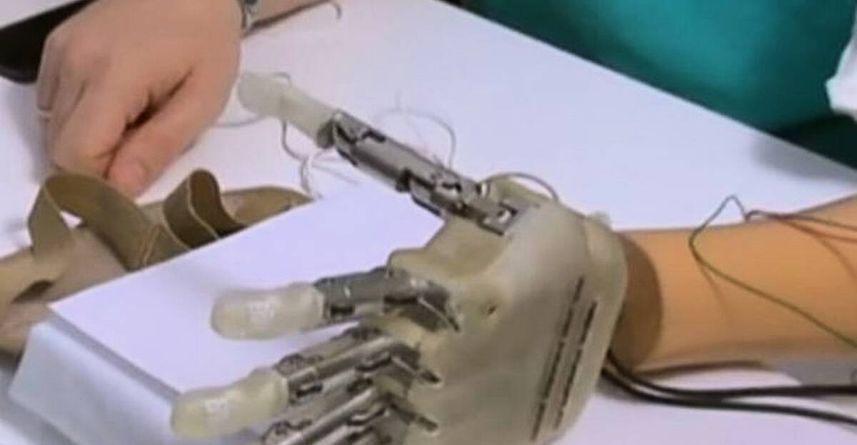 Audio Bionic Hand Restores Amputees Sense Of Touch Newstalk